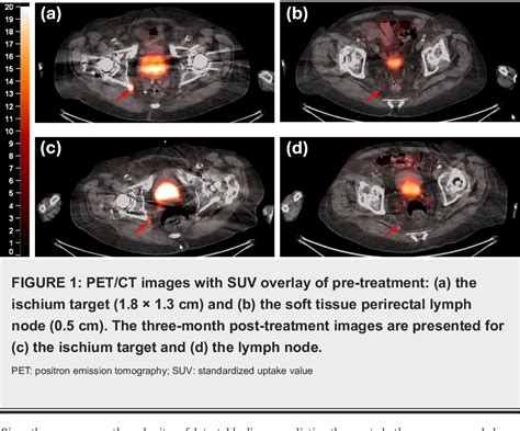 Figure 1 From Adaptive Driven Ct Simulation Free Soft Tissue Stereotactic Body Radiation Therapy