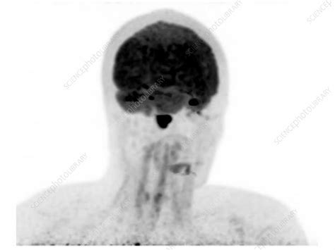 B Cell Lymphoma PET Scan Stock Video Clip K Science Photo Library