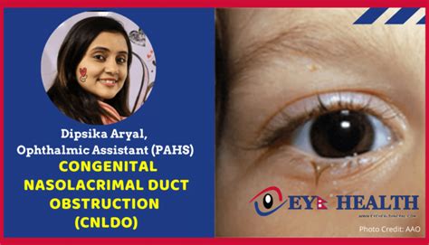 Congenital Nasolacrimal Duct Obstruction Cnldo Eye Health Nepal