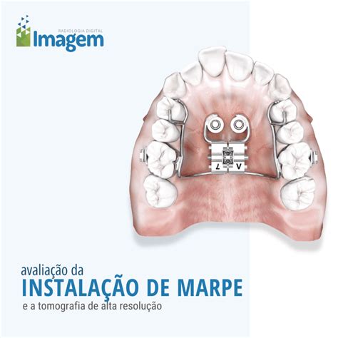 Avaliação Da Instalação De Marpe E A Tomografia De Alta Resolução