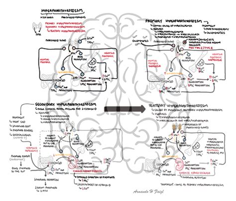 Hyperparathyroidism Armando Hasudungan