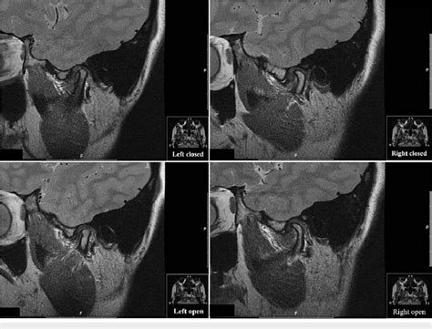 Magnetic Resonance Imaging Of The Left And Right Tmj Temporal Fossa