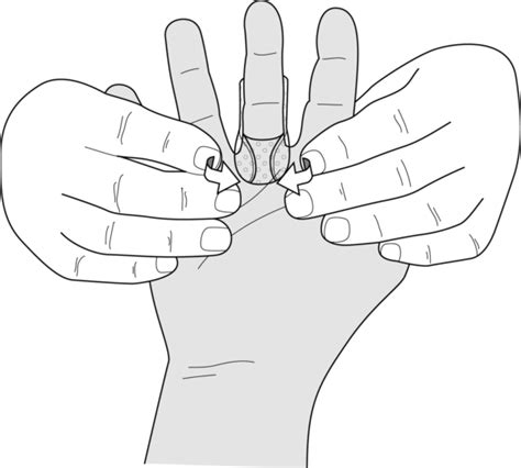 Guide Pip Extension Splints