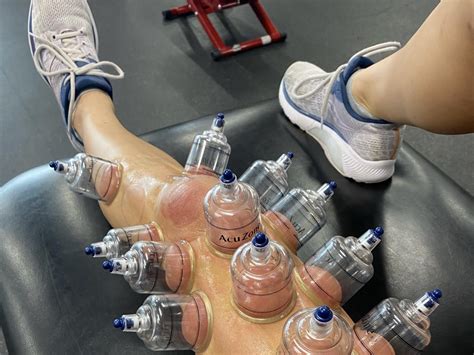 Cupping Available Treatments Peak Performance Sports And Spine Ctr