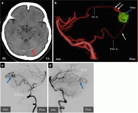 Three Cerebellar Arteries Superior Cerebellar Artery Anterior Inferior Cerebellar Artery And