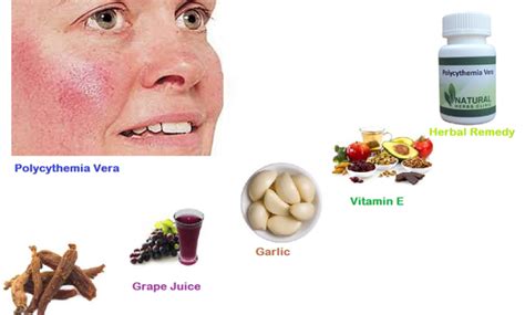 Herbal Remedies For Polycythemia Vera Symptoms Cause Treatment