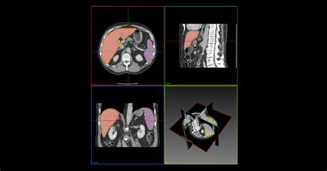 Monai Label For Ai Assisted Medical Image Annotation Use Case Nvidia