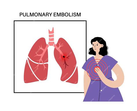 Enfermedad de embolia pulmonar | Vector Premium