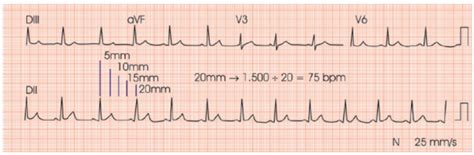 Tema 3 Lectura Del Electrocardiograma