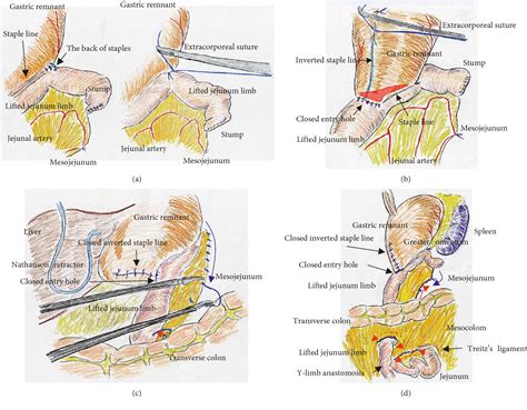 Figure 2 From Overlap Anastomosis For Digestive Reconstruction During Laparoscopic Distal