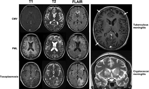 Brain Mri Of Snc Opportunistic Infections In Hiv Aids Cmv Increased Download Scientific
