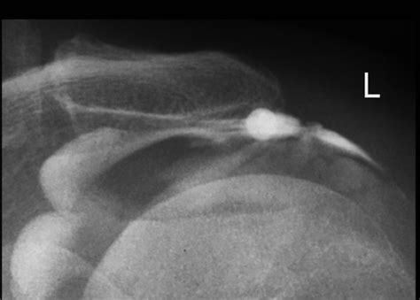Imaging Guided Subacromial Injection Showing Contrast In The Download Scientific Diagram