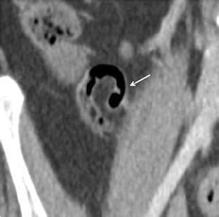 Normal Appearance Of The Appendix On Ct The Normal Appendix Arrow Download Scientific