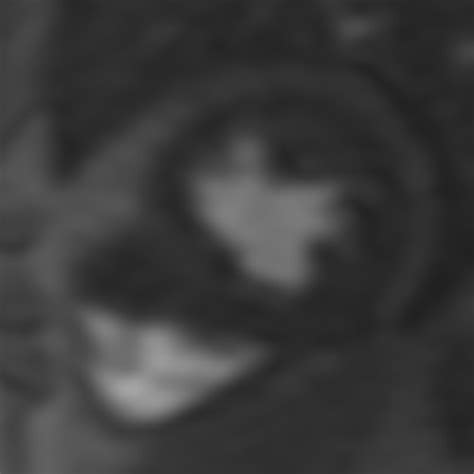 Cardiac Hydatid Cyst As A Rare Presentation Of Echinococcal Disease