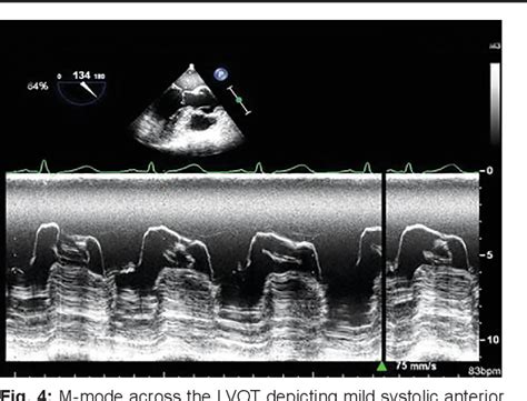 Figure 4 From Role Of Perioperative Tee In Diagnosing And Management Of A Case Of Dynamic Lvot