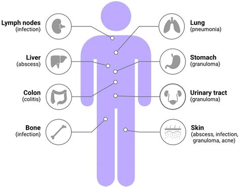 Chronic Granulomatous Disease Causes Symptoms Diagnosis And Treatment