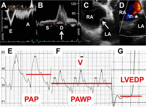 A Transesophageal Echocardiography With Pulsed Wave Doppler Signal Of Download Scientific