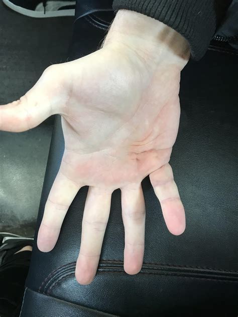 Partial Fasciectomy R Surgery