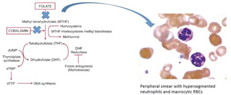 Macrocytic Anemia And Pathophysiology Flashcards Quizlet