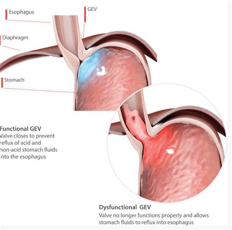 Nissen Fundoplication Laparoscopic Nissen Fundoplication Medical