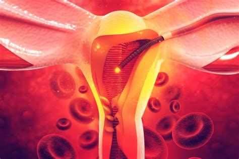 Laparoscopic Myomectomy Vs Open Myomectomy For Treating Uterine Fibroids
