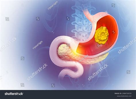 Stomach Cancer Gastric Cancer Symptoms Stages Stock Illustration