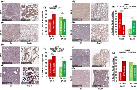 Ca Ix And Or Ca Xii Is Expressed In Flt3 Itd⁺ Aml Patients Failing Download Scientific Diagram