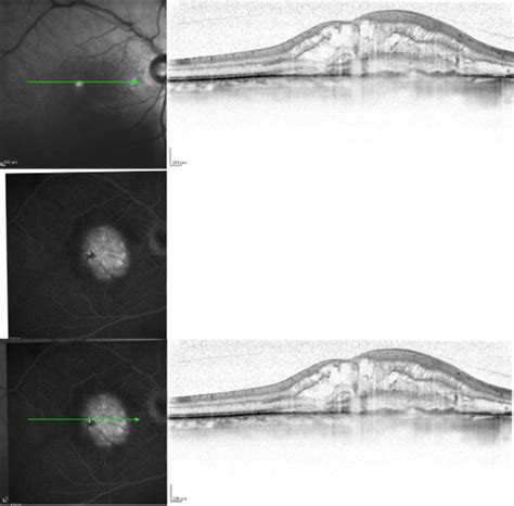 Diagnostic Evaluation Of Type 2 Classic Choroidal Neovascularization Optical Coherence