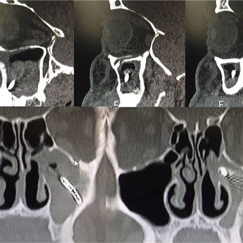 Sinus Computed Tomography Ct Executed Without Contrast Evidenced The Download Scientific