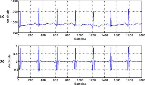 Figure 1 From Detection Of Qrs Complexes In Ecg Signals Based On