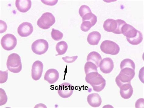 Schistocyte Schizocyte Fragmentocyte Fragmented Rbs Due To Rupture In The Peripheral