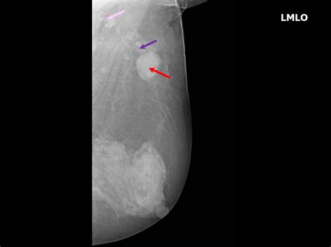 Posterior Axillary Lymph Nodes