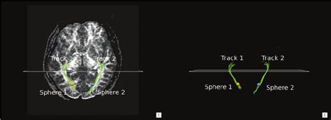 Diffusion Tensor Dt Mri Fibre Tracking And Extraction Of Optic Download Scientific Diagram
