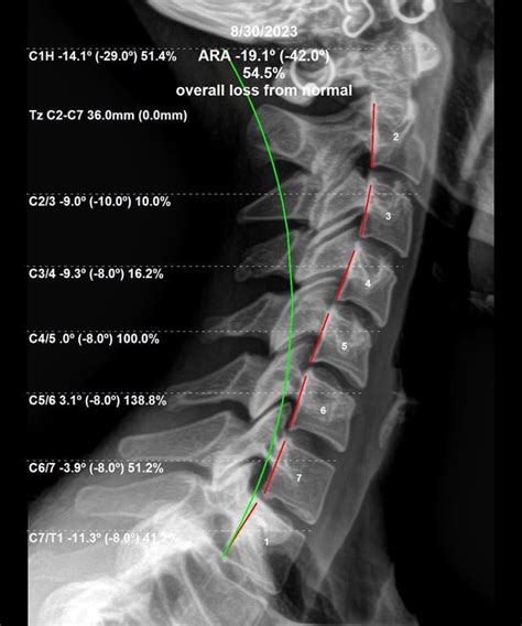 Chiropractor Told Me My Thyroid Is Calcified Rradiology