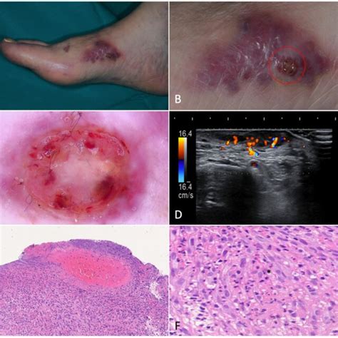 Nodular Kaposis Sarcoma A Hyperkeratotic Nodules On The Left Download Scientific Diagram