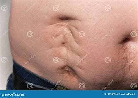 Ugly Bad Scar On The Man`s Fat Belly After The Appendicitis Surgery