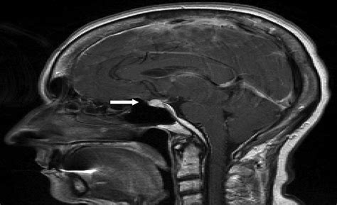 Radionuclide Cisternography In Detecting Cerebrospinal Fluid