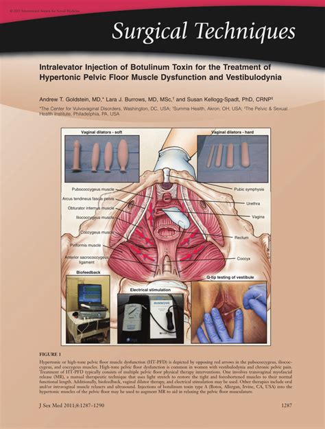 Pdf Intralevator Injection Of Botulinum Toxin For The Treatment Of