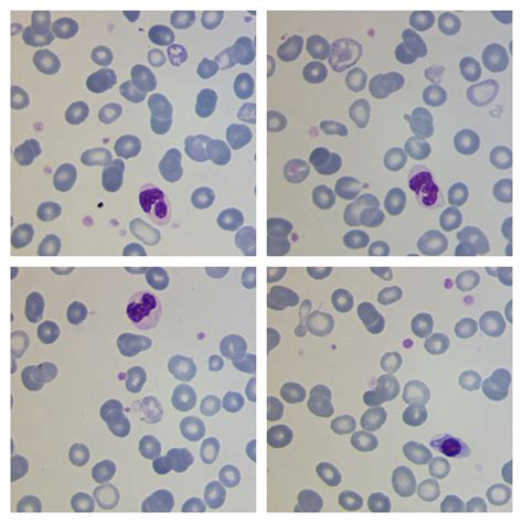 Sindrome MielodisplÁsico Con Sf3b1 Mutado