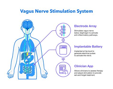 Nerve Stimulation Device For Ibd Implanted In Melb Man