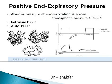 Ventilator Presentation1 Full File Pptx
