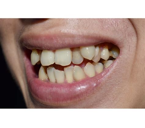 What Is Impacted Tooth At Annie Spafford Blog