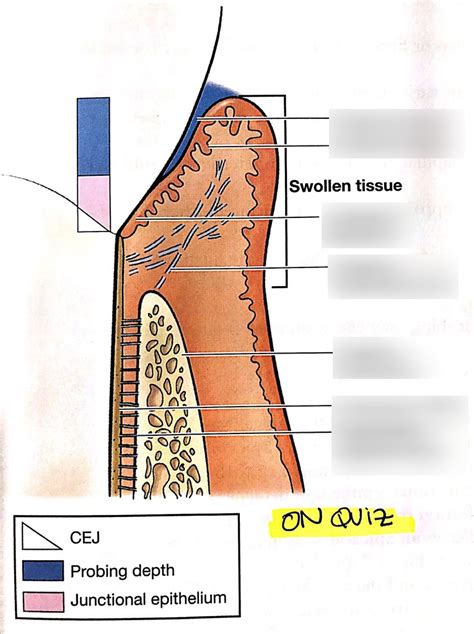 GINGIVITIS Diagram Quizlet