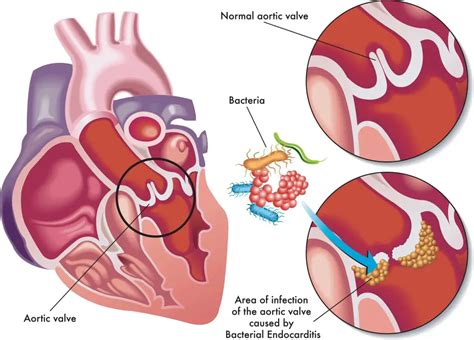 Nclex Heart Disease Endocarditis