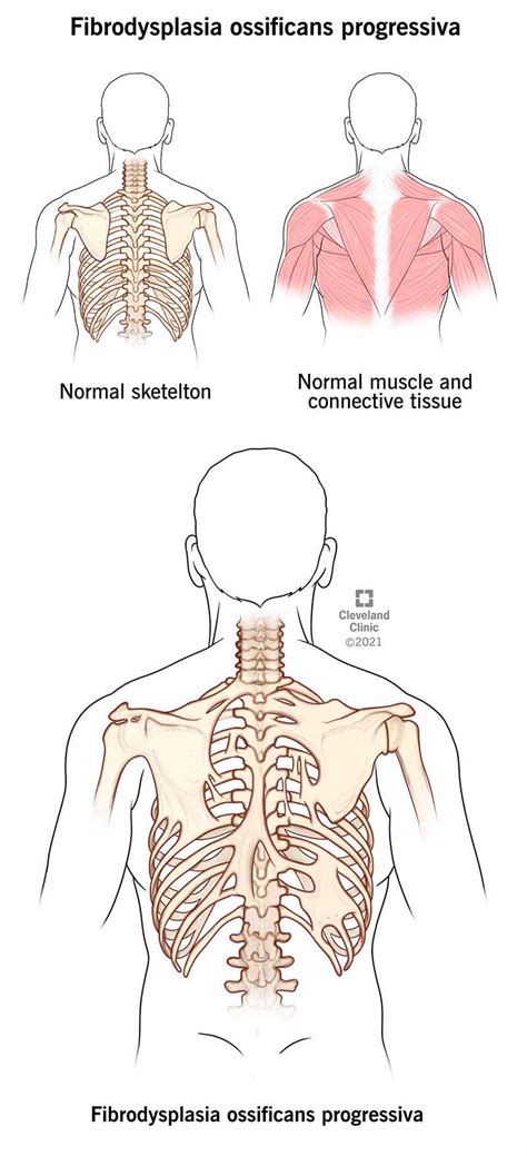 Stone Man Disease Symptoms