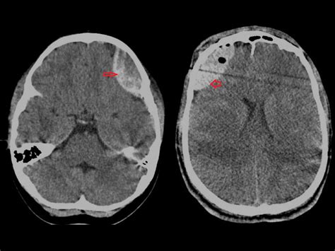 Hematoma Extradural Ou Hematoma Epidural Hed Neurolink