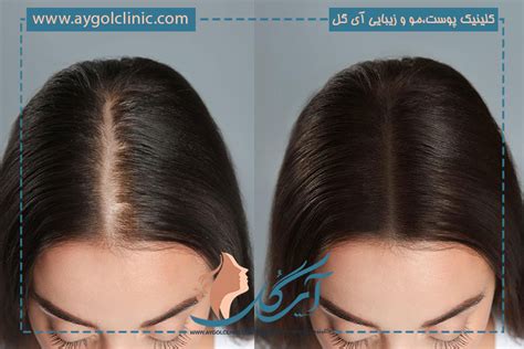 کاشت مو به روش تکثیر؛ نحوه انجام آن آی گل