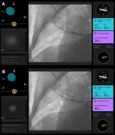 Robotic Assisted Bronchoscopy Combined With Multimodal Imaging For Targeted Lung Cryobiopsies