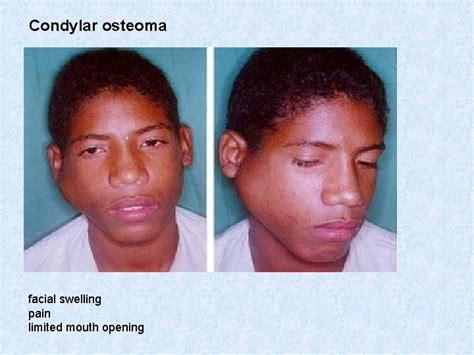 Osteoma Benign Neoplasms Of Bone Forming Tissue Essentially
