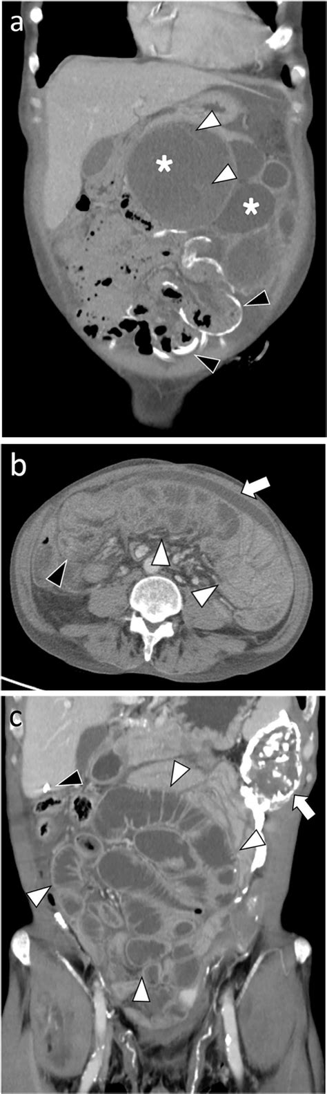 Imaging Pearls And Differential Diagnosis Of Encapsulating Peritoneal